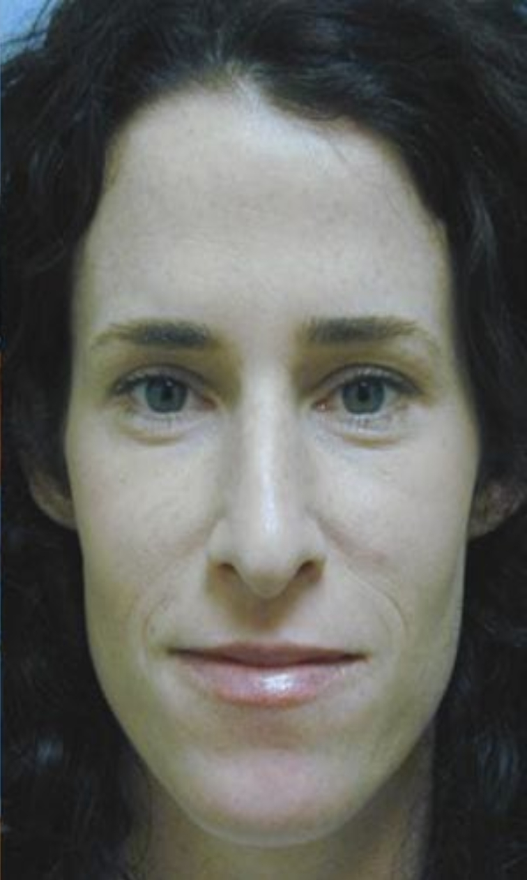 Rhinoplasty & Nasal Reconstruction Gallery | The Williams Center ...