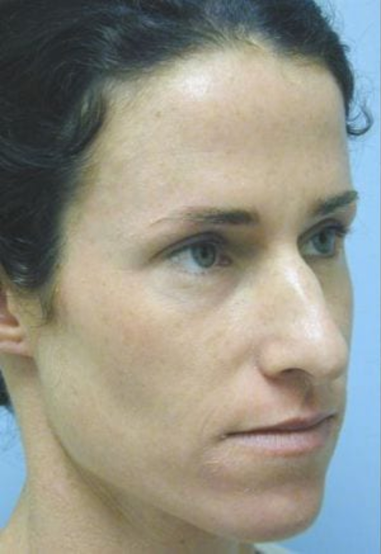 Rhinoplasty & Nasal Reconstruction Gallery | The Williams Center ...