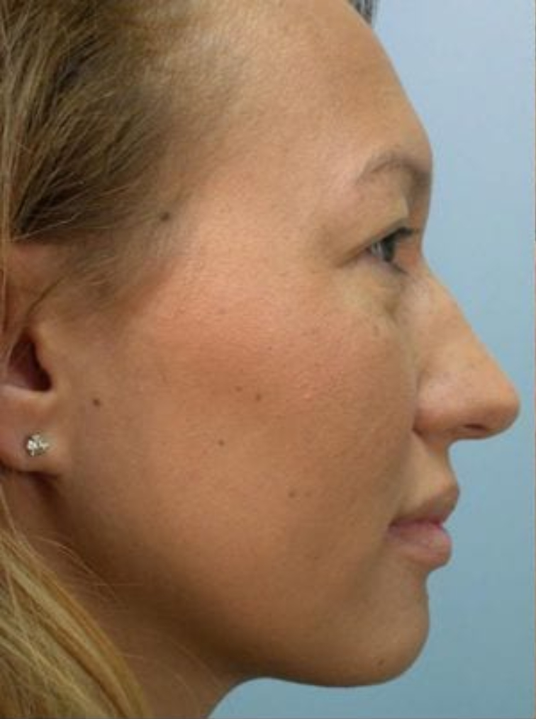 Rhinoplasty & Nasal Reconstruction Pictures | Williams Center Williams ...