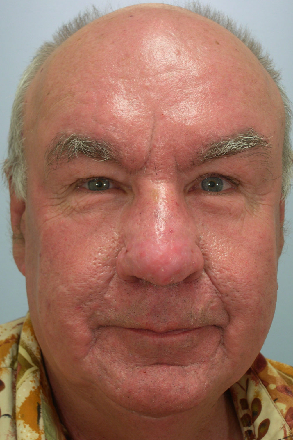 Rhinophyma Surgery - Before & After Photos | Williams Center Williams ...