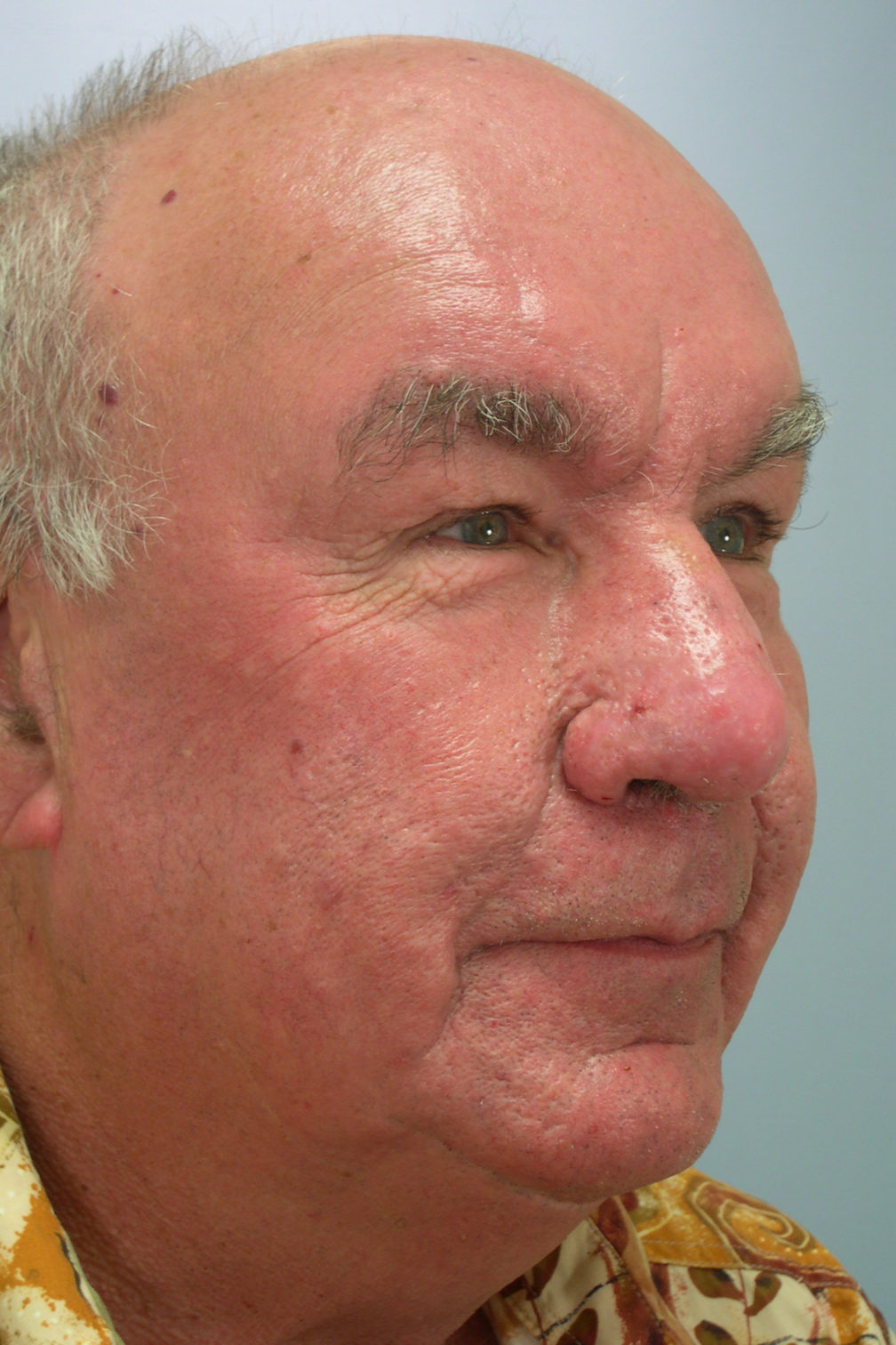 Rhinophyma Surgery - Before & After Photos | Williams Center Williams ...