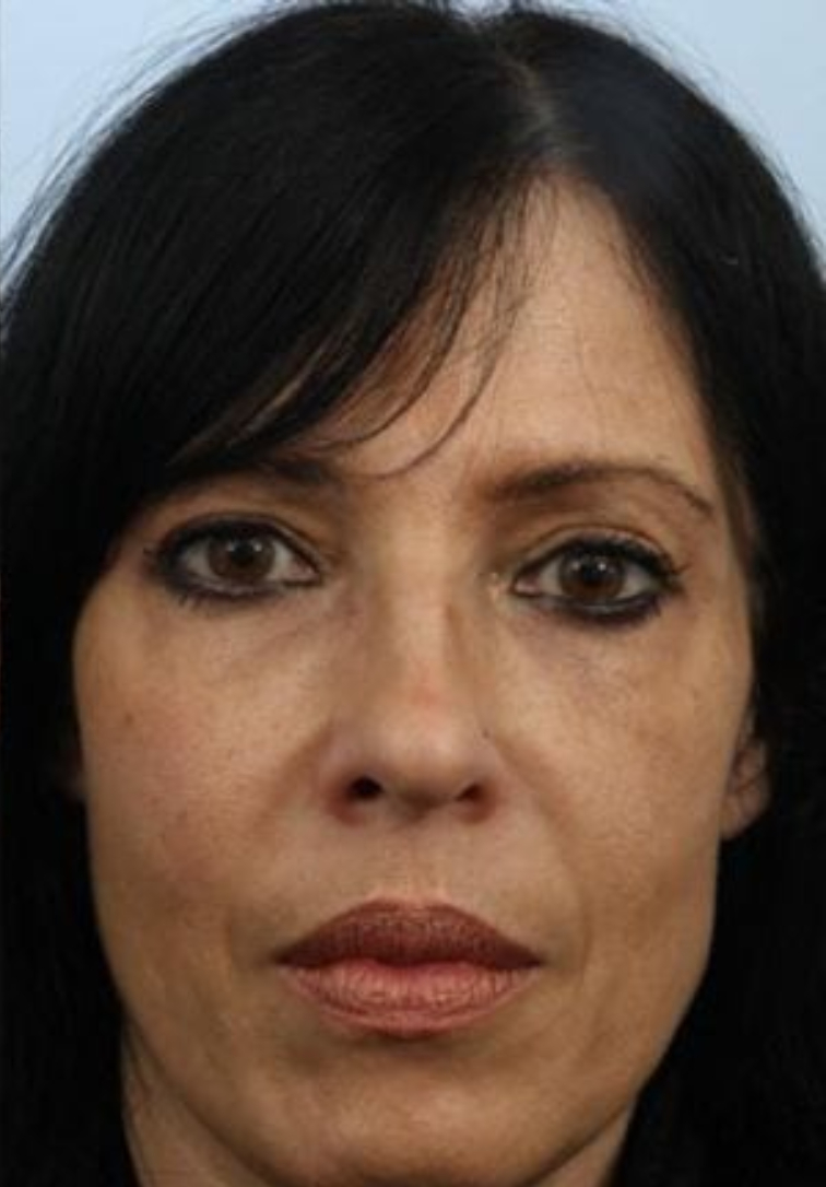 Blepharoplasty Pictures - Eyelid Surgery | Williams Center Williams Center