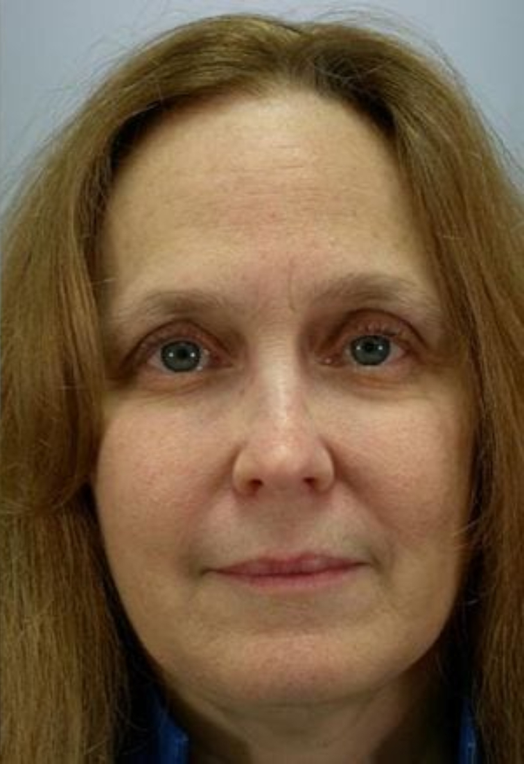 Facial Fat Transfer Surgery Pictures | Williams Center Williams Center