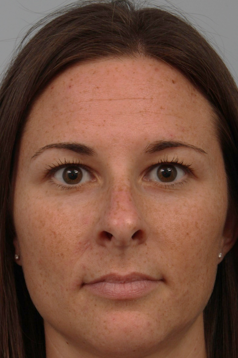 Blepharoplasty Pictures - Eyelid Surgery | Williams Center Williams Center