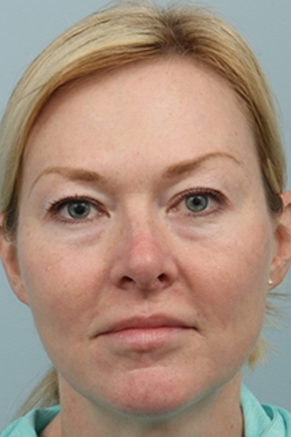 Blepharoplasty Pictures - Eyelid Surgery | Williams Center Williams Center