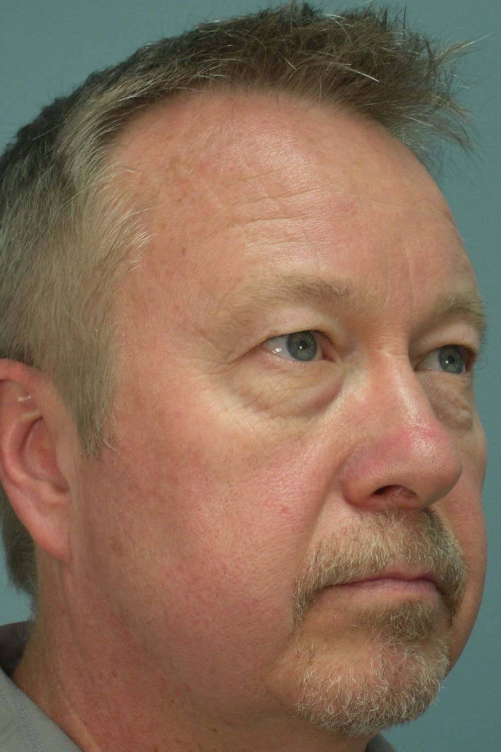 Blepharoplasty Pictures - Eyelid Surgery | Williams Center Williams Center