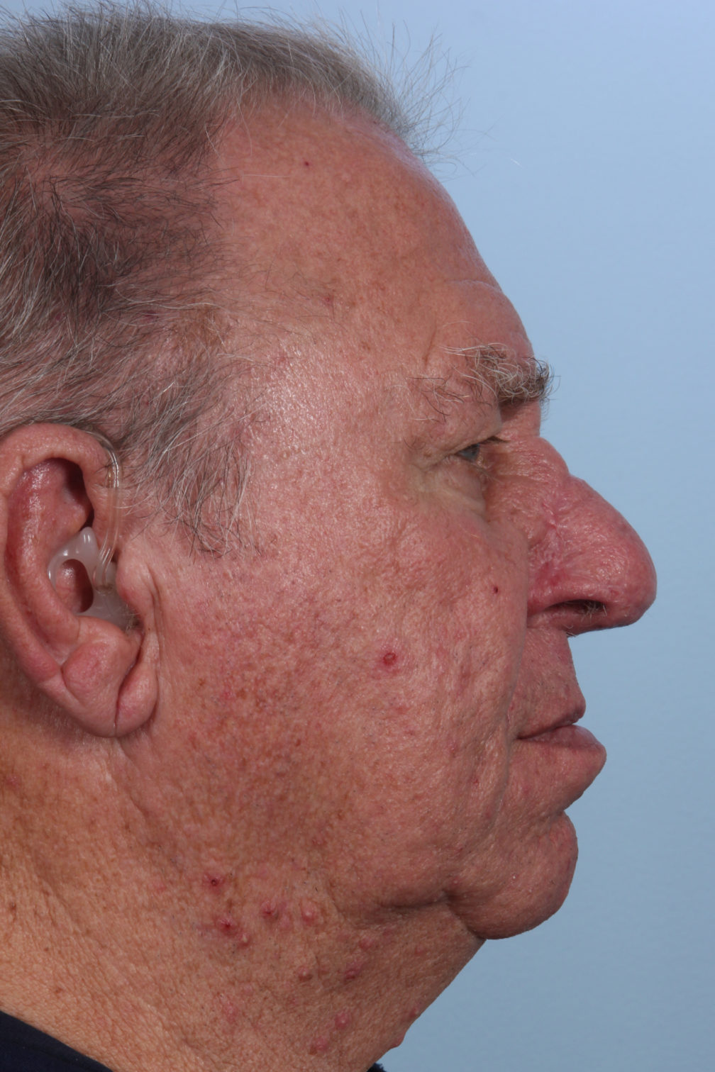 Rhinophyma Surgery - Before & After Photos | Williams Center Williams ...