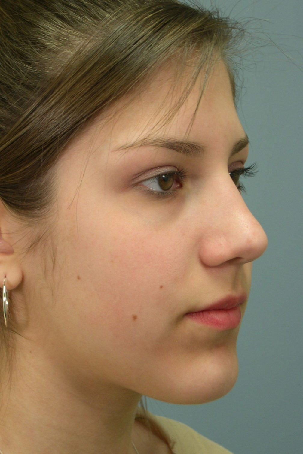 Rhinoplasty & Nasal Reconstruction Pictures | Williams Center Williams ...