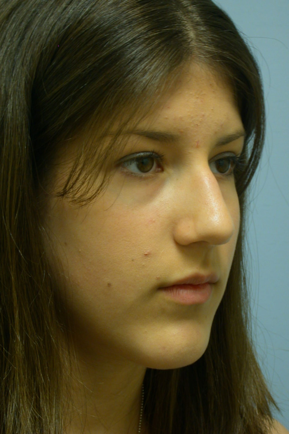 Rhinoplasty & Nasal Reconstruction Pictures | Williams Center Williams ...