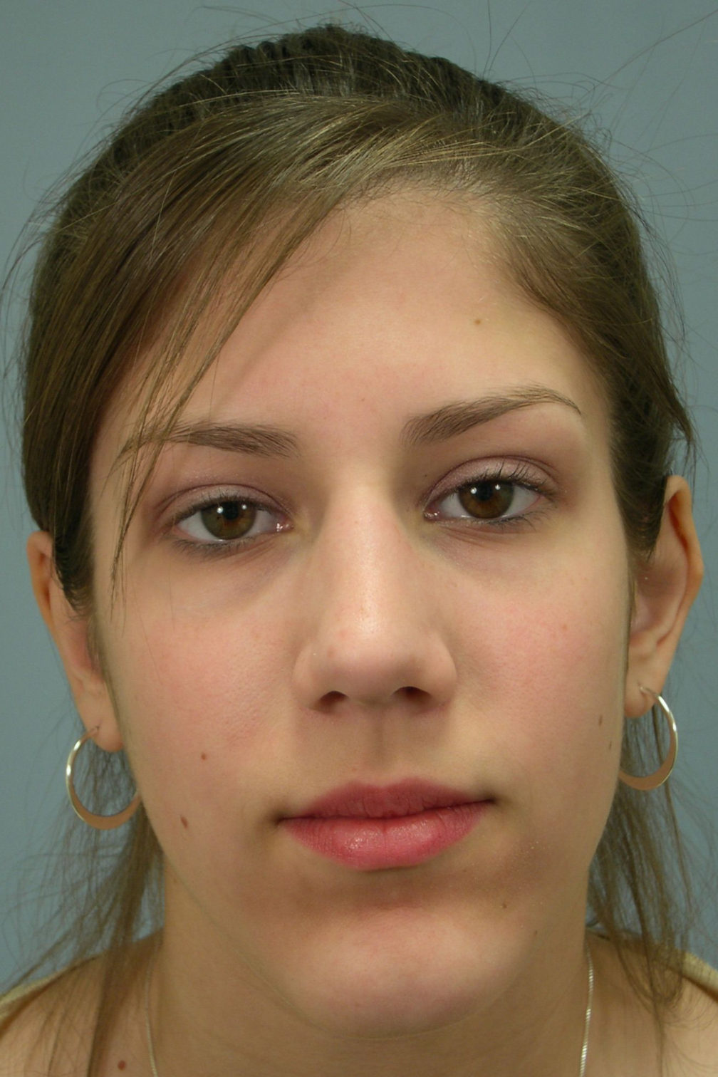 Rhinoplasty & Nasal Reconstruction Pictures | Williams Center Williams ...