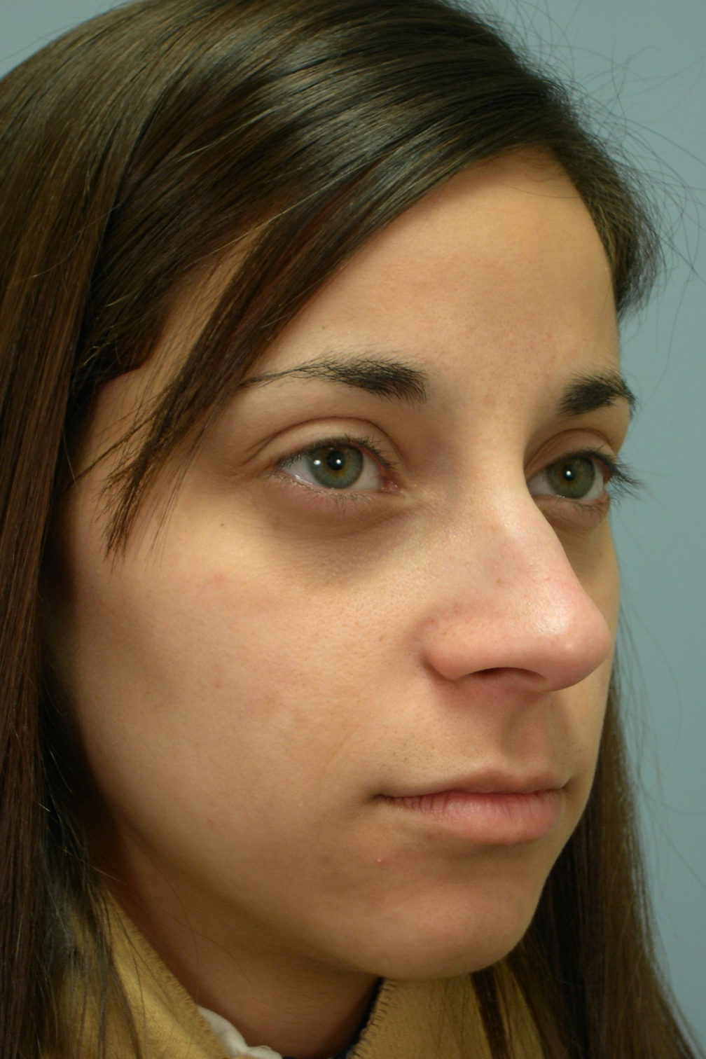Rhinoplasty & Nasal Reconstruction Pictures | Williams Center Williams ...
