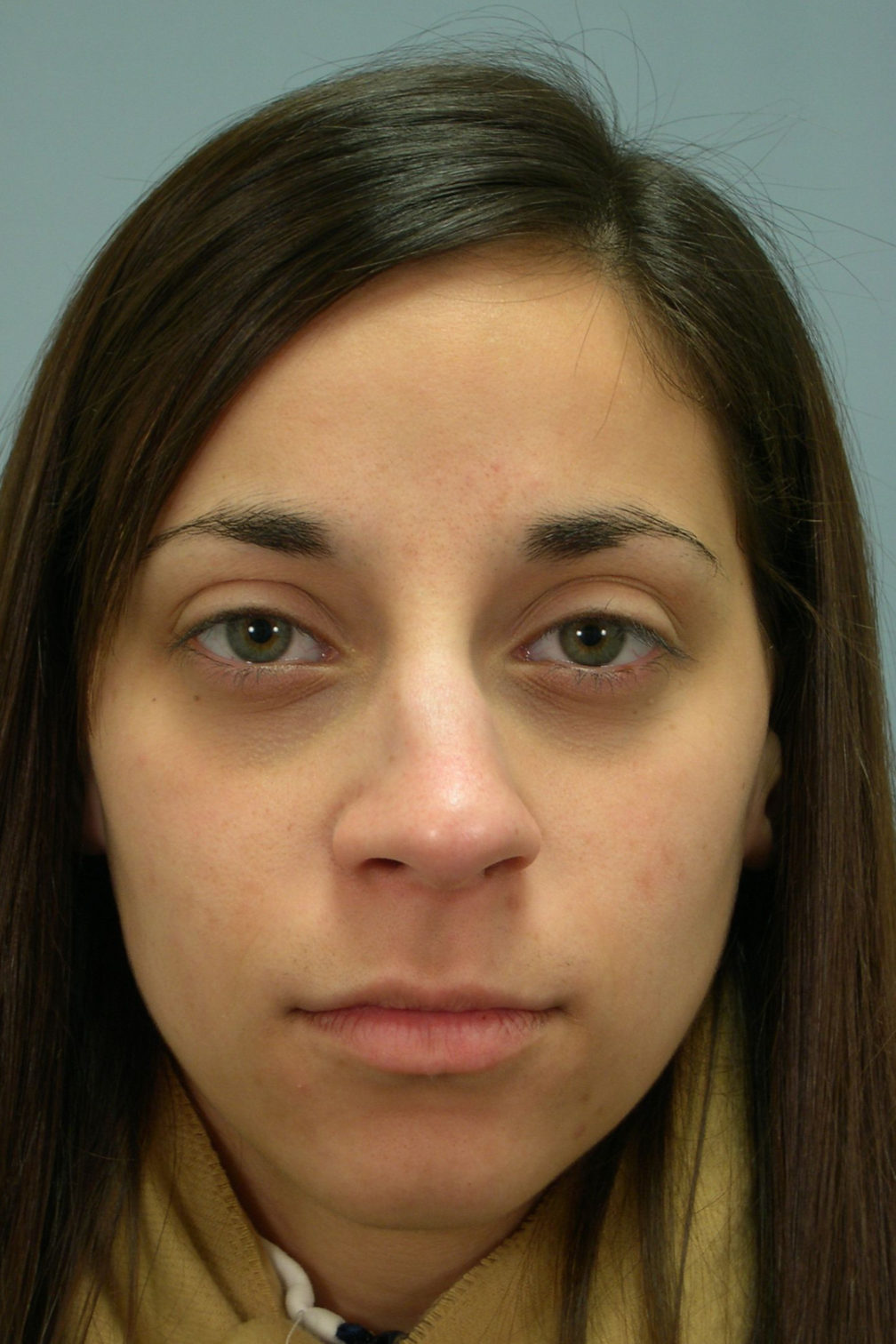 Rhinoplasty & Nasal Reconstruction Pictures | Williams Center Williams ...