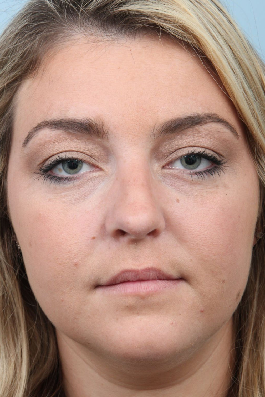 Rhinoplasty & Nasal Reconstruction Pictures | Williams Center Williams ...