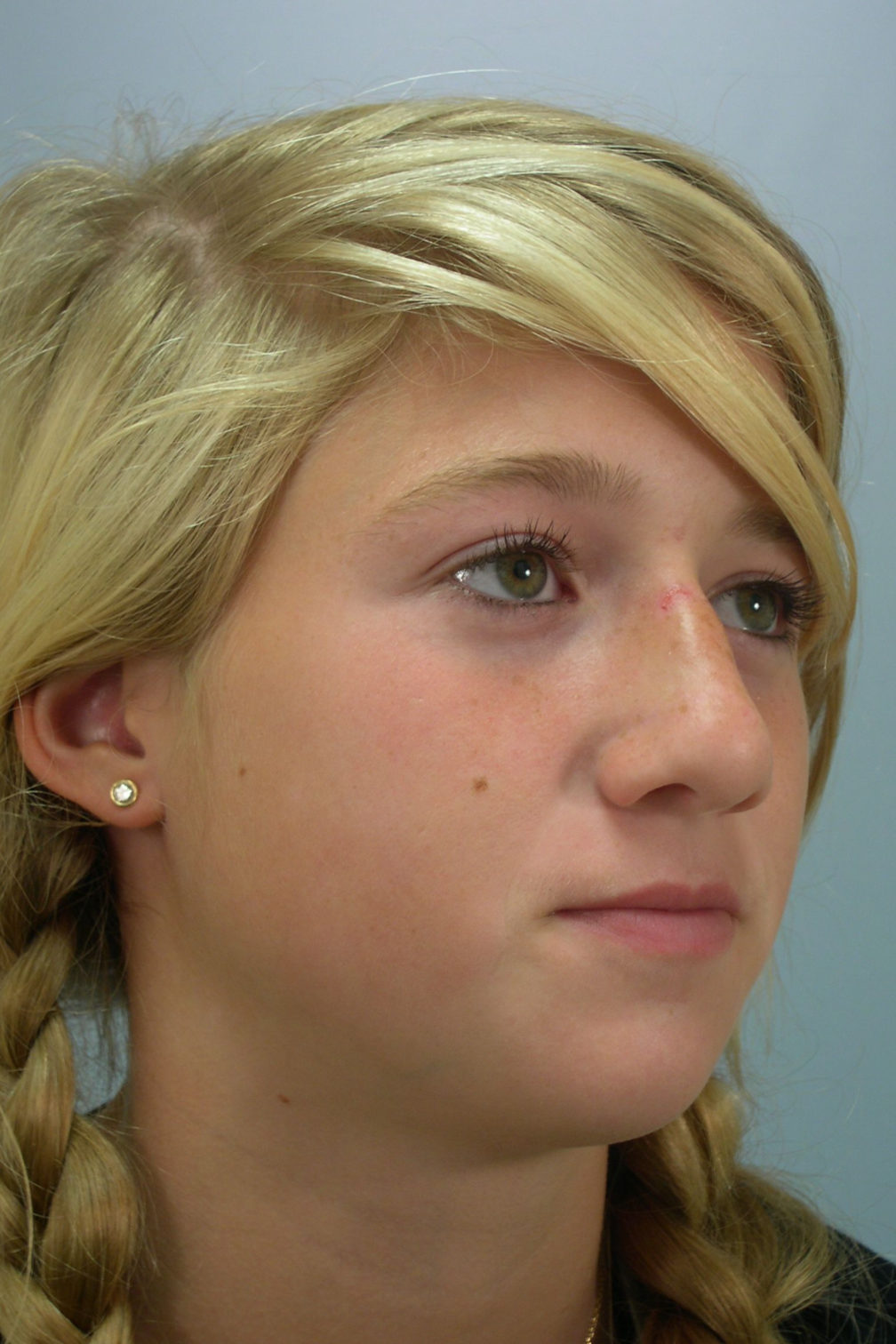 Rhinoplasty & Nasal Reconstruction Pictures | Williams Center Williams ...