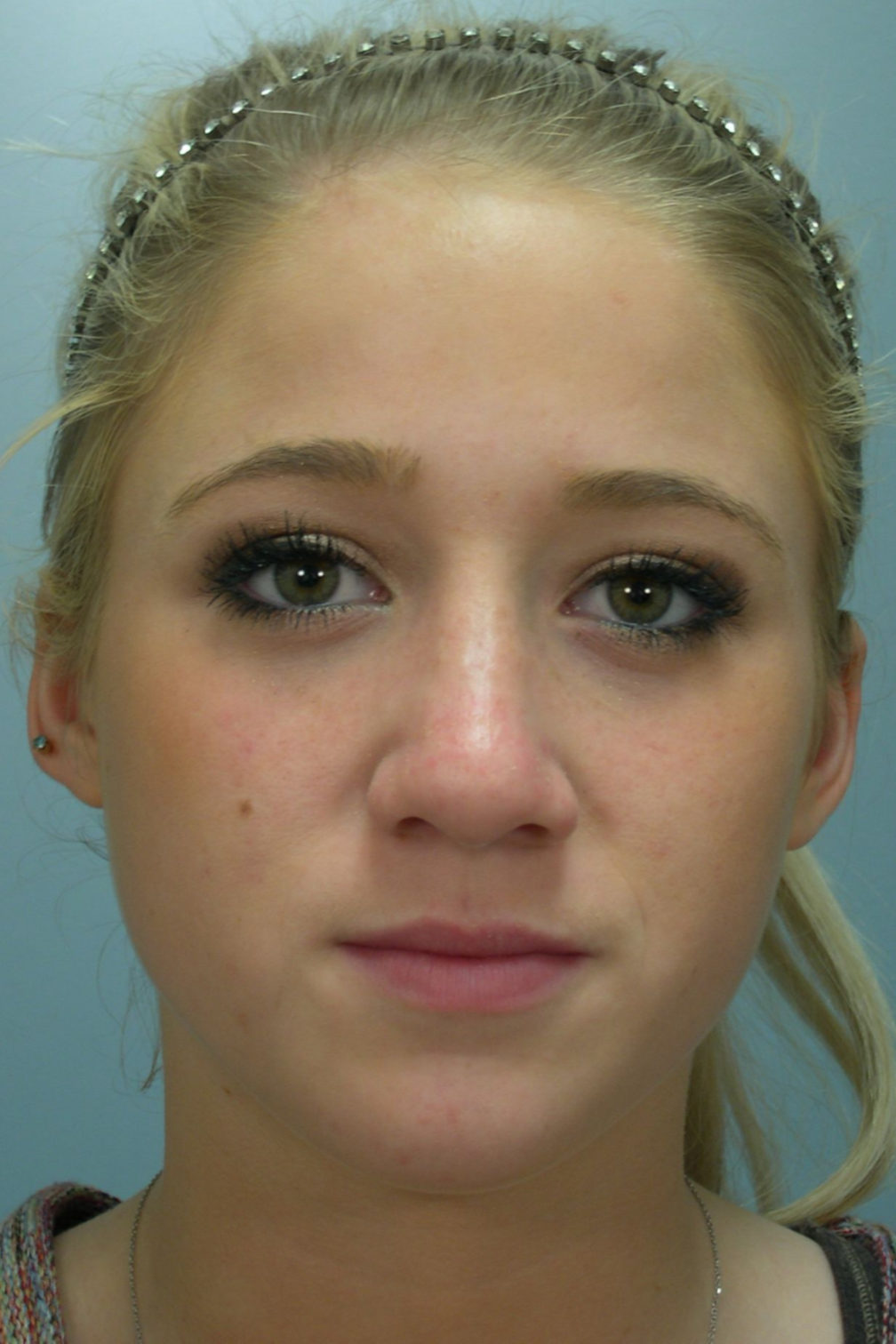 Rhinoplasty & Nasal Reconstruction Pictures | Williams Center Williams ...