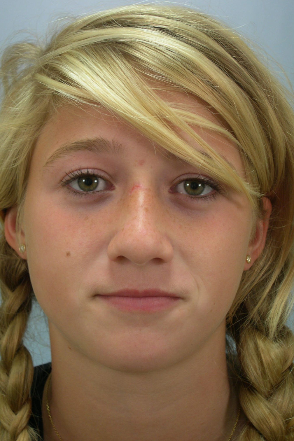 Rhinoplasty & Nasal Reconstruction Pictures | Williams Center Williams ...