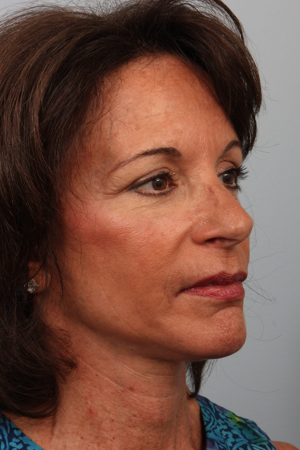 Deep Plane Facelift Before & After Pictures | Williams Center Williams ...