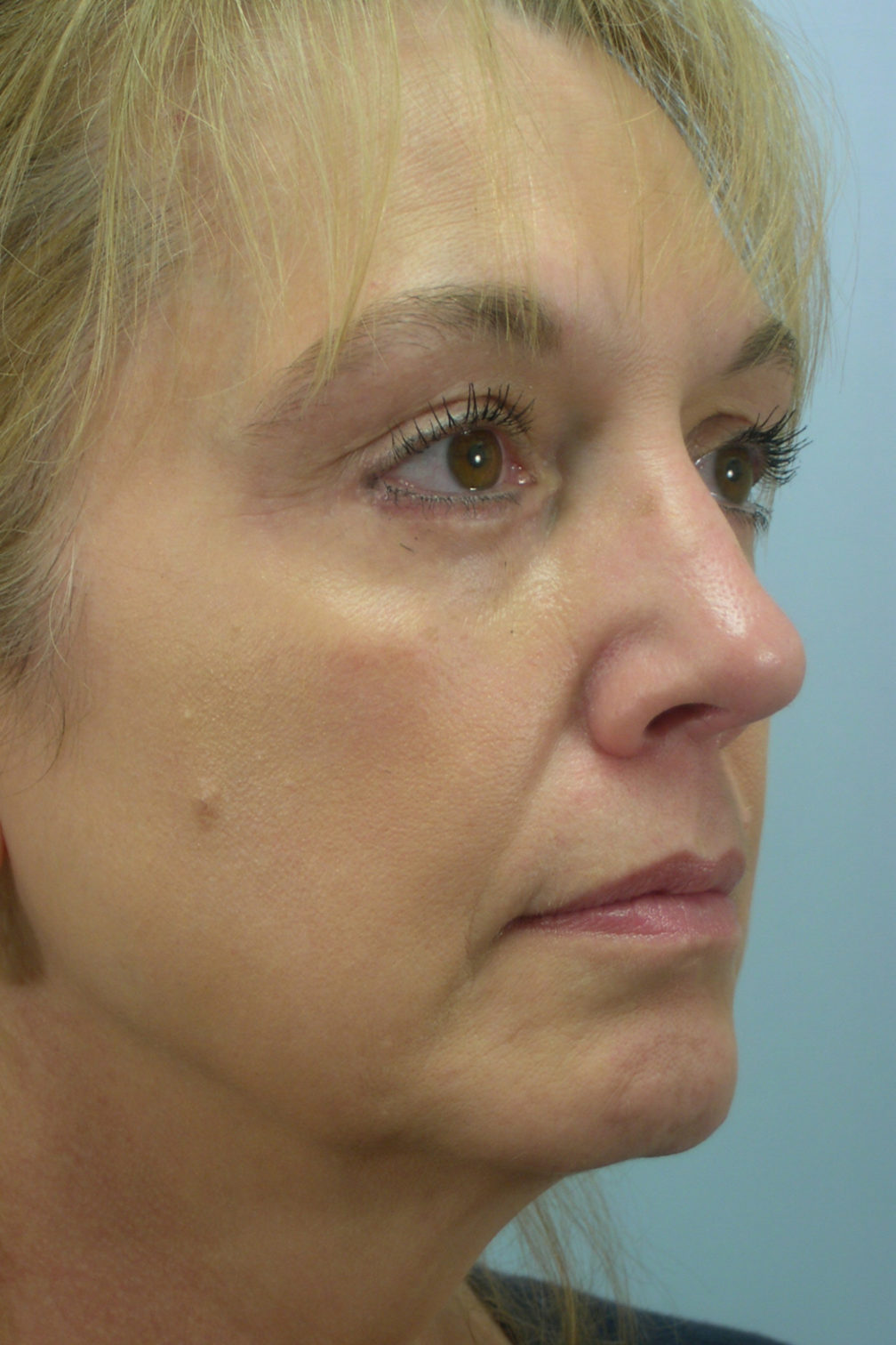 Facial Procedures Archives - Page 21 of 42 - Williams Center Williams ...