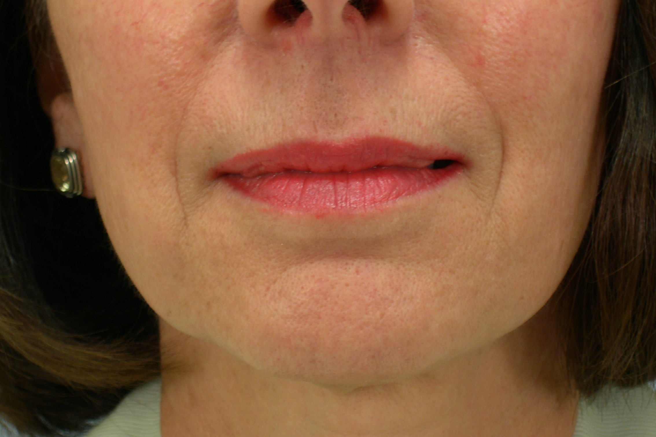 Facial Fat Transfer Surgery Pictures | Williams Center Williams Center