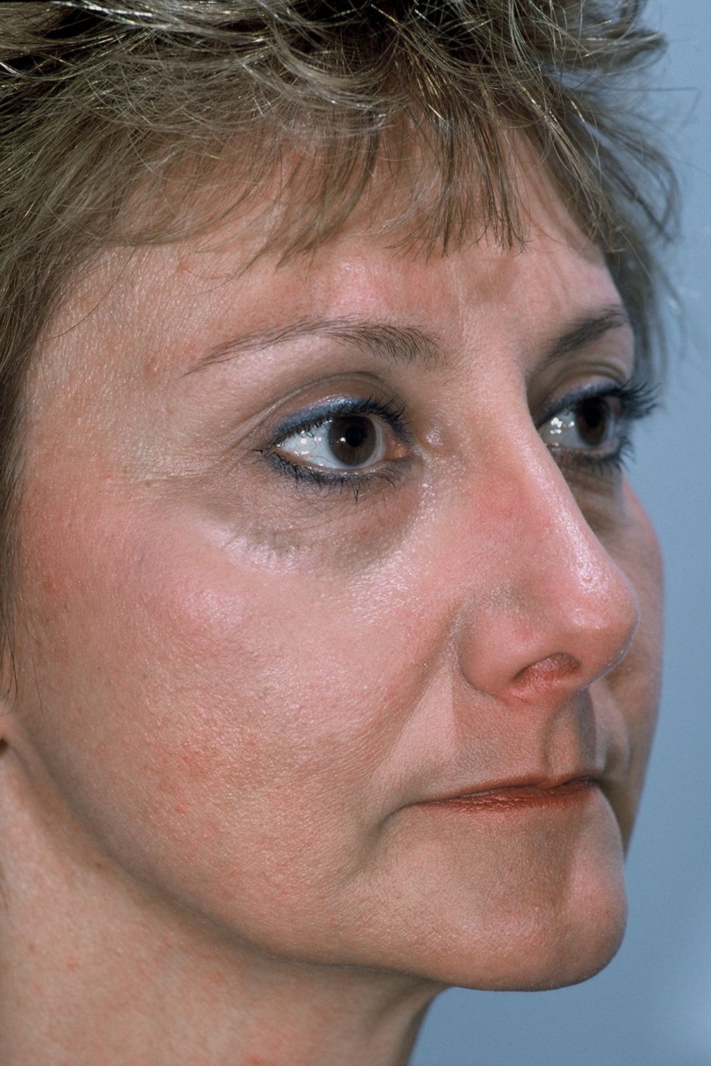 Rhinoplasty & Nasal Reconstruction Pictures | Williams Center Williams ...