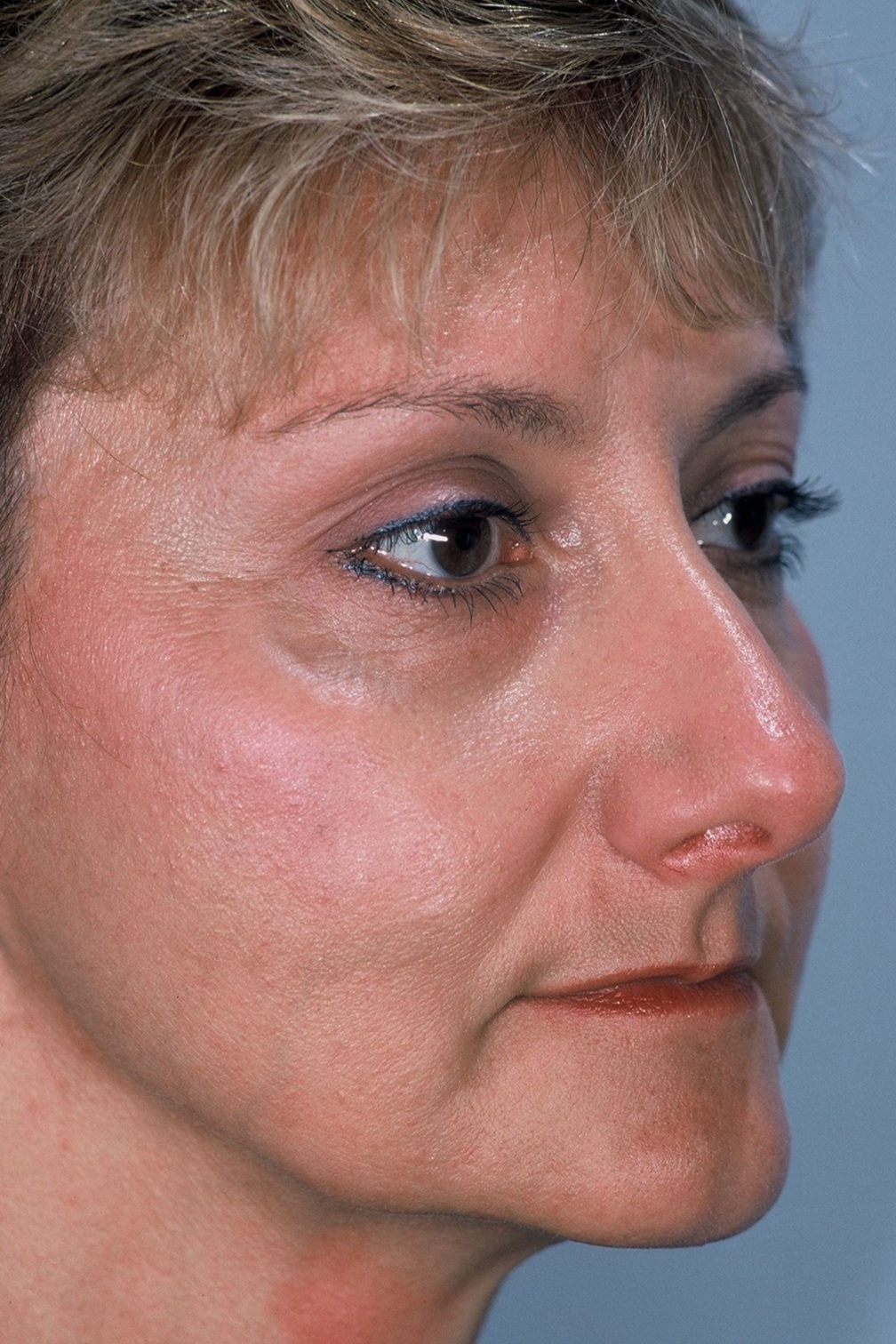 Rhinoplasty & Nasal Reconstruction Pictures | Williams Center Williams ...