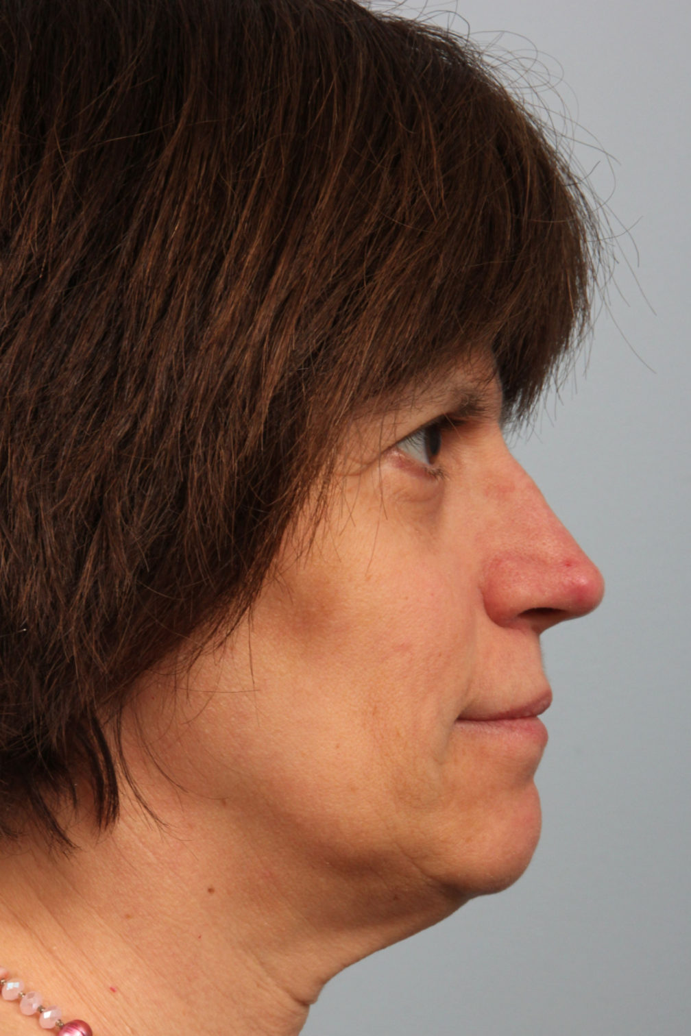 Rhinoplasty & Nasal Reconstruction Pictures | Williams Center Williams ...