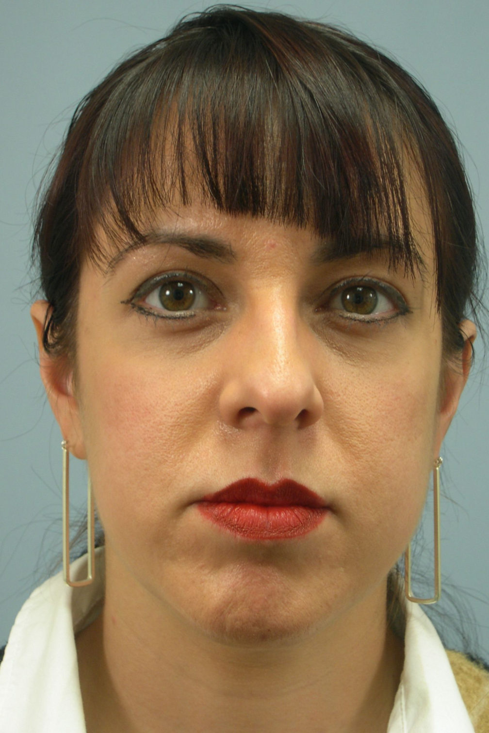 Rhinoplasty & Nasal Reconstruction Pictures | Williams Center Williams ...