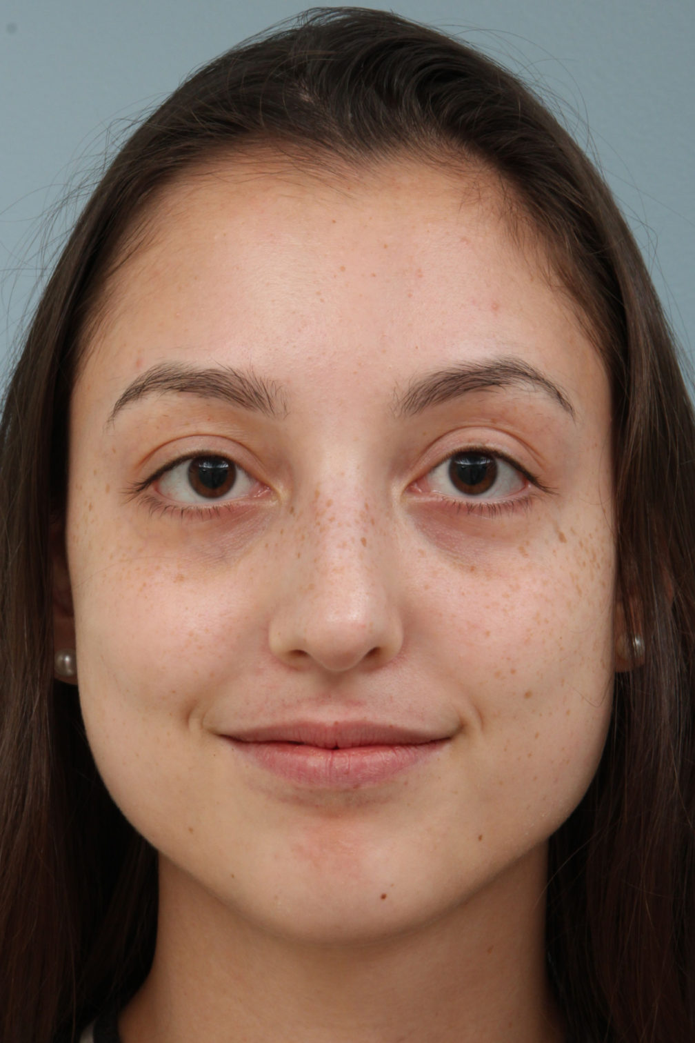 Rhinoplasty & Nasal Reconstruction Pictures | Williams Center Williams ...