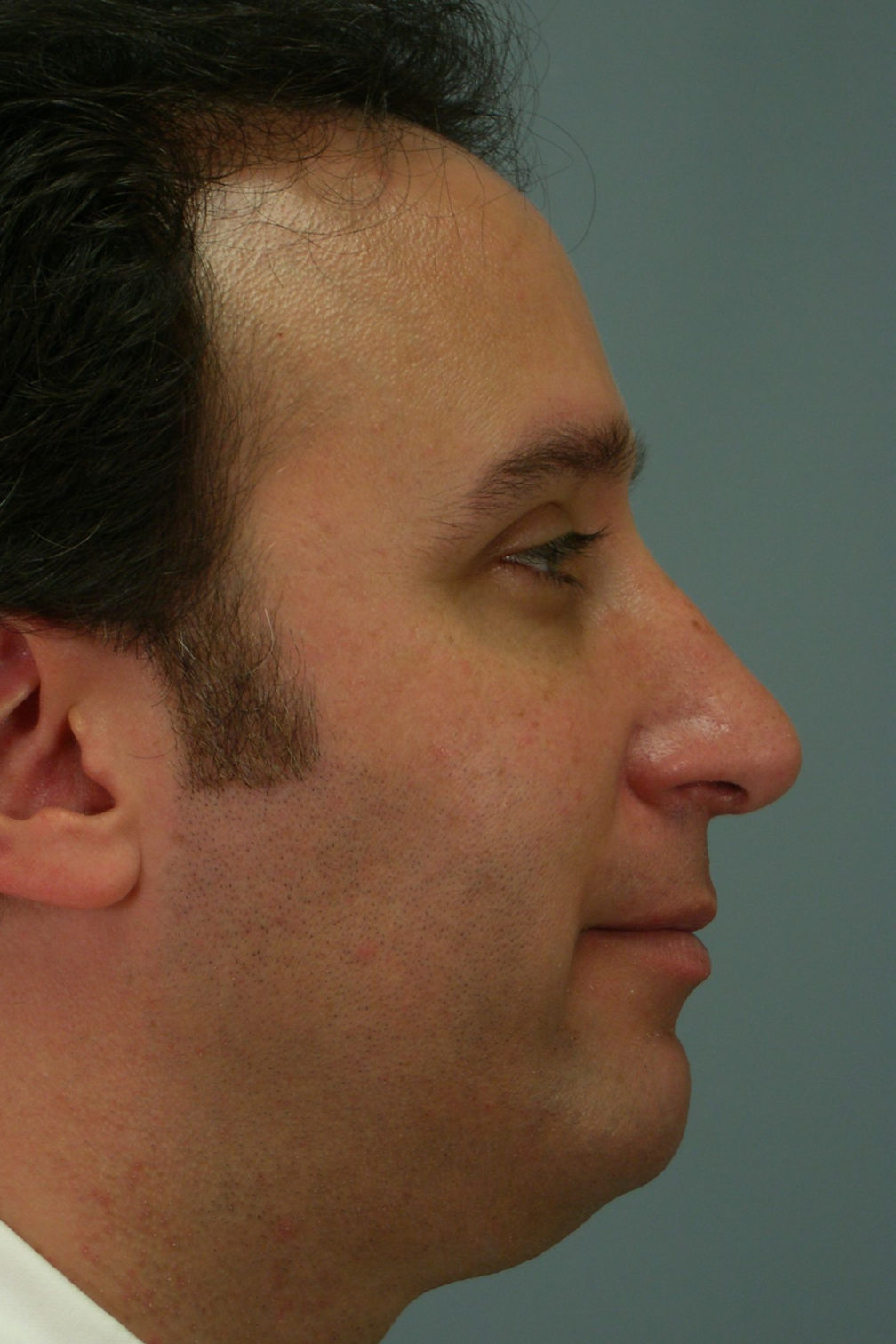 Rhinoplasty & Nasal Reconstruction Pictures | Williams Center Williams ...