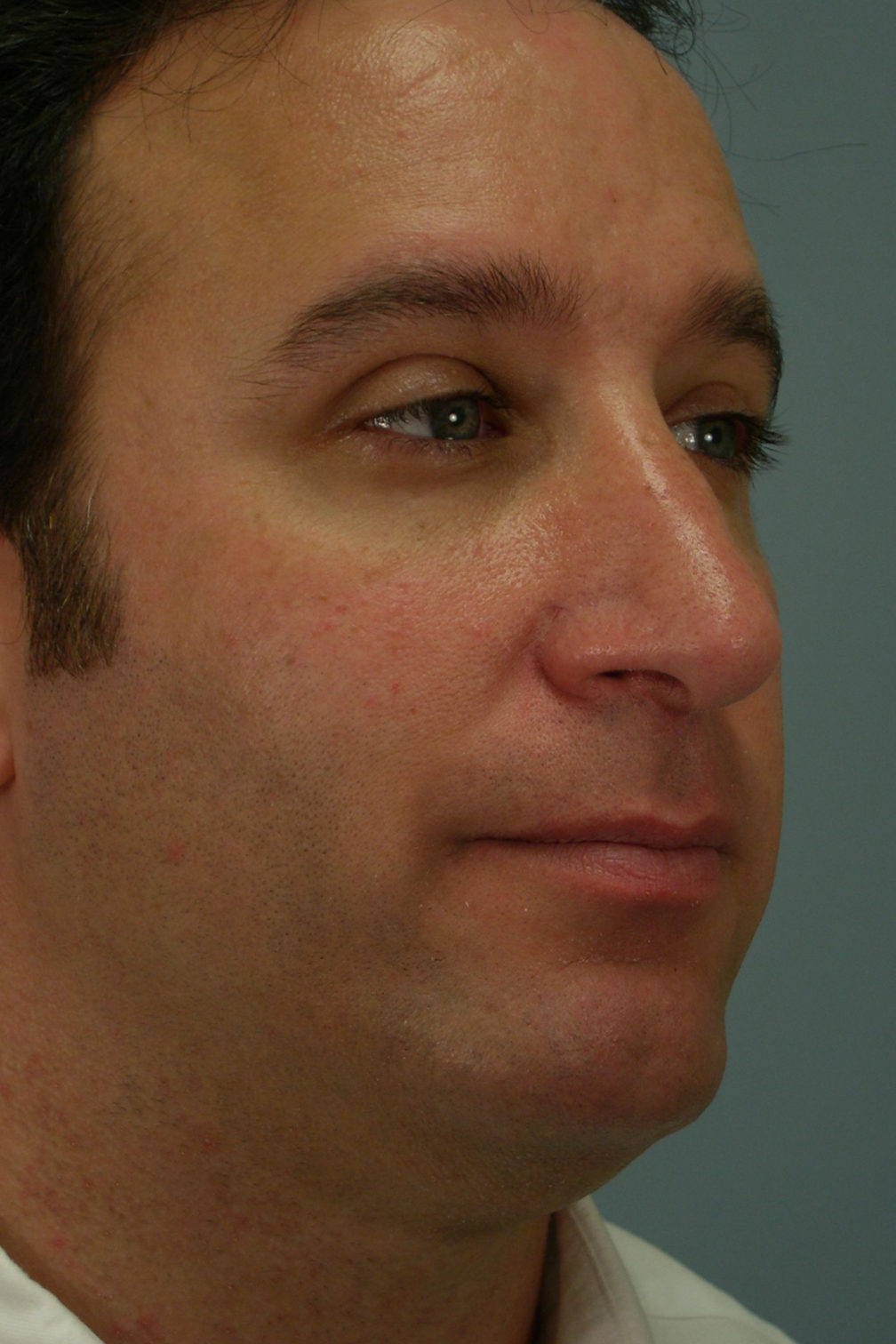 Rhinoplasty & Nasal Reconstruction Pictures | Williams Center Williams ...