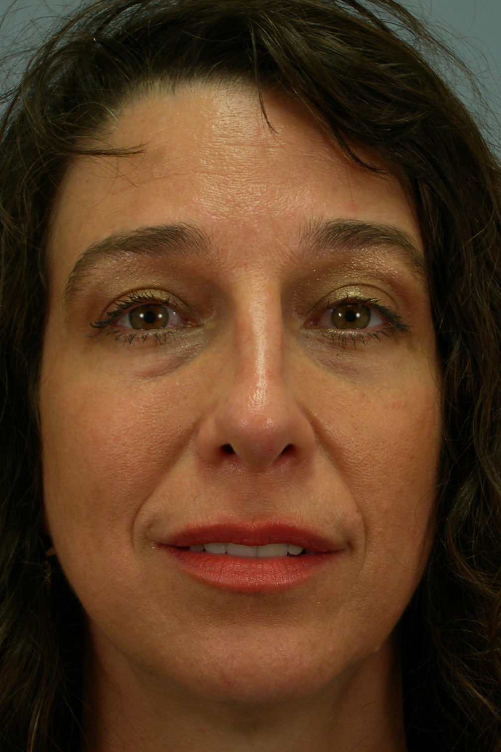 Rhinoplasty & Nasal Reconstruction Pictures | Williams Center Williams ...