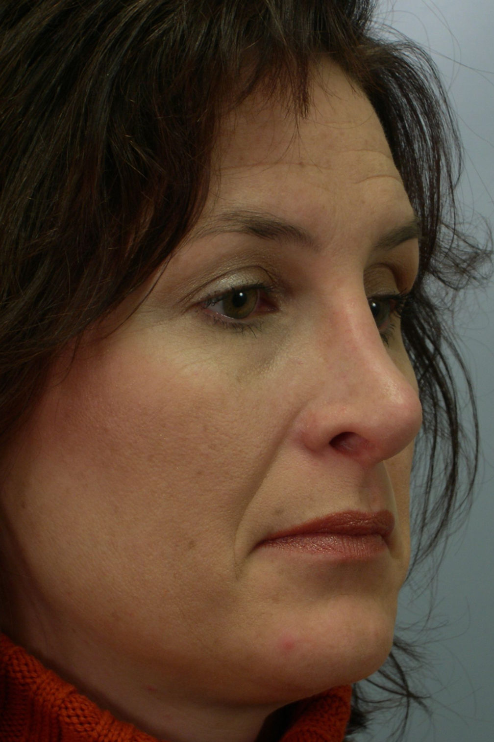 Rhinoplasty & Nasal Reconstruction Gallery | The Williams Center ...