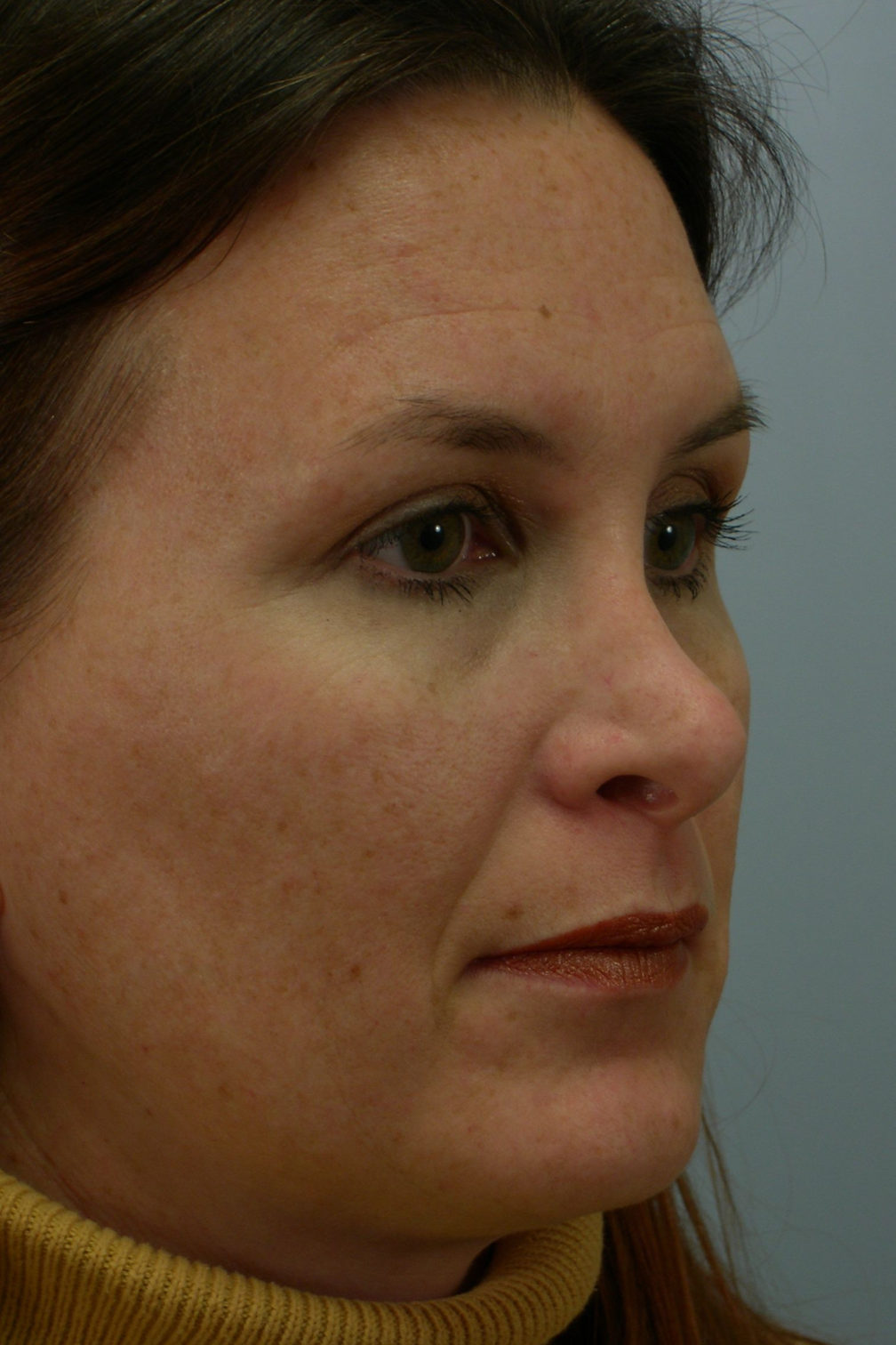 Rhinoplasty & Nasal Reconstruction Gallery | The Williams Center ...
