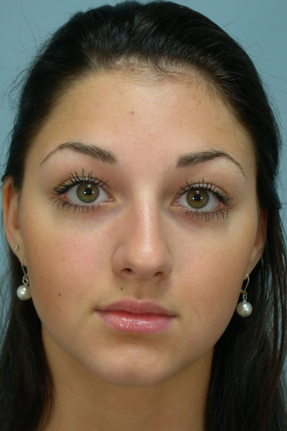 Rhinoplasty & Nasal Reconstruction Pictures | Williams Center Williams ...