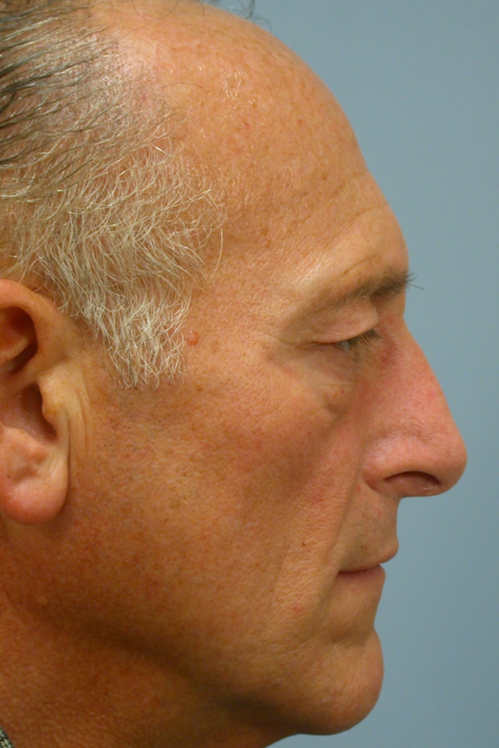 Photos of Minimal Invasive Endoscopic Results | Williams Center ...