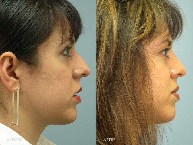 RNR020 | Cosmetic Rhinoplasty Albany, Latham, Saratoga NY - Williams ...