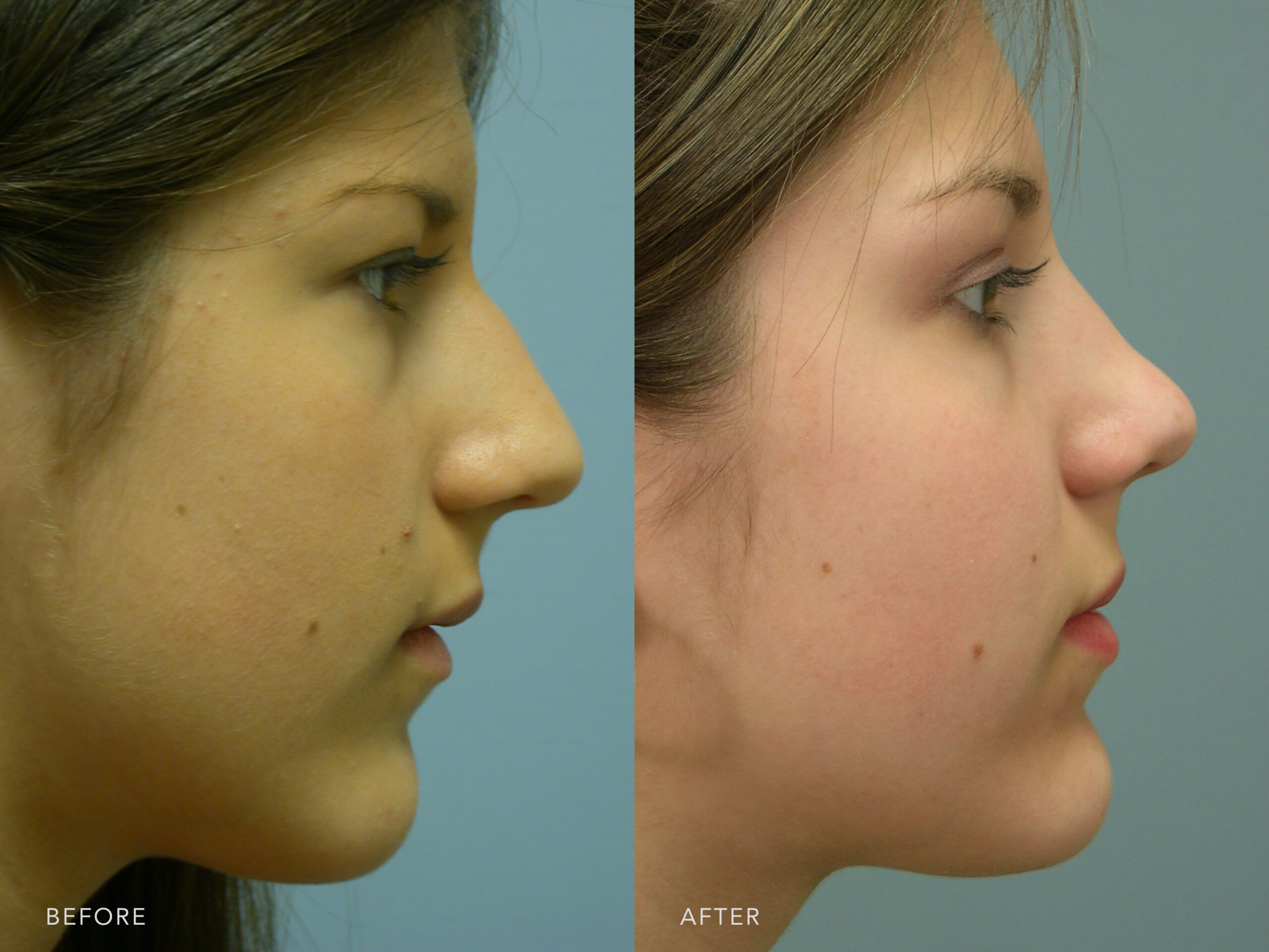 Rhinoplasty Plastic Surgery Procedure | Williams Center Williams Center