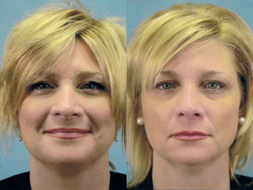 Nasal Tip Rhinoplasty Surgery | Williams Center Williams Center