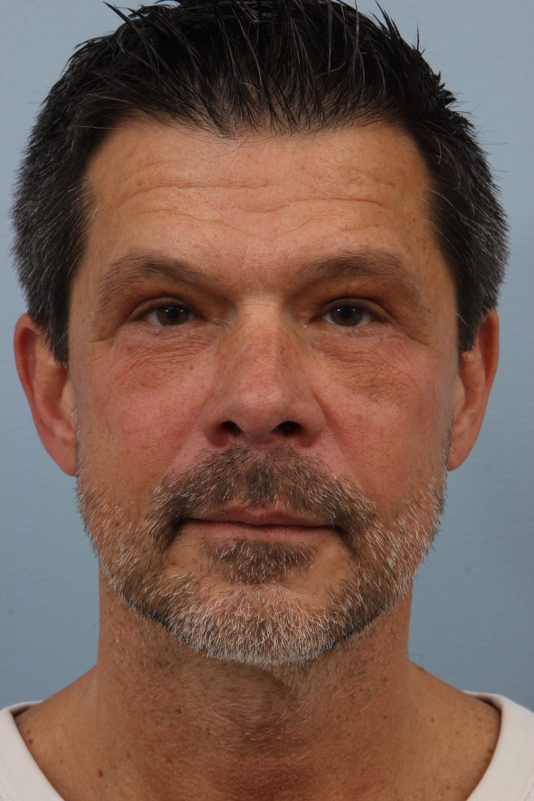 Blepharoplasty Gallery | The Williams Center Williams Center