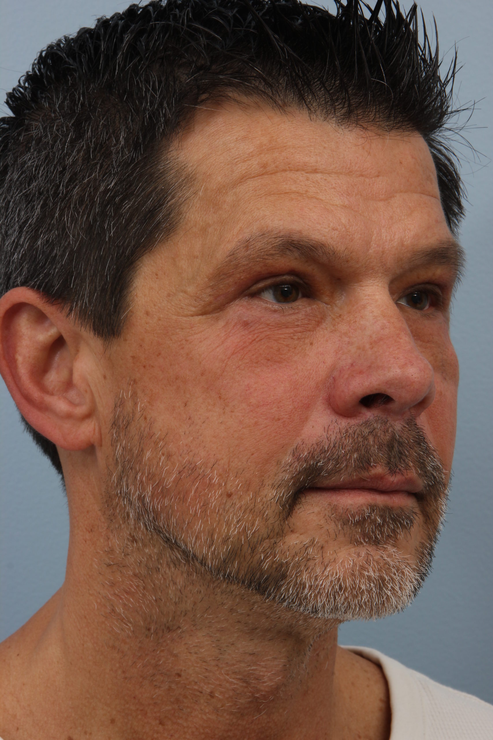 Blepharoplasty Gallery | The Williams Center Williams Center