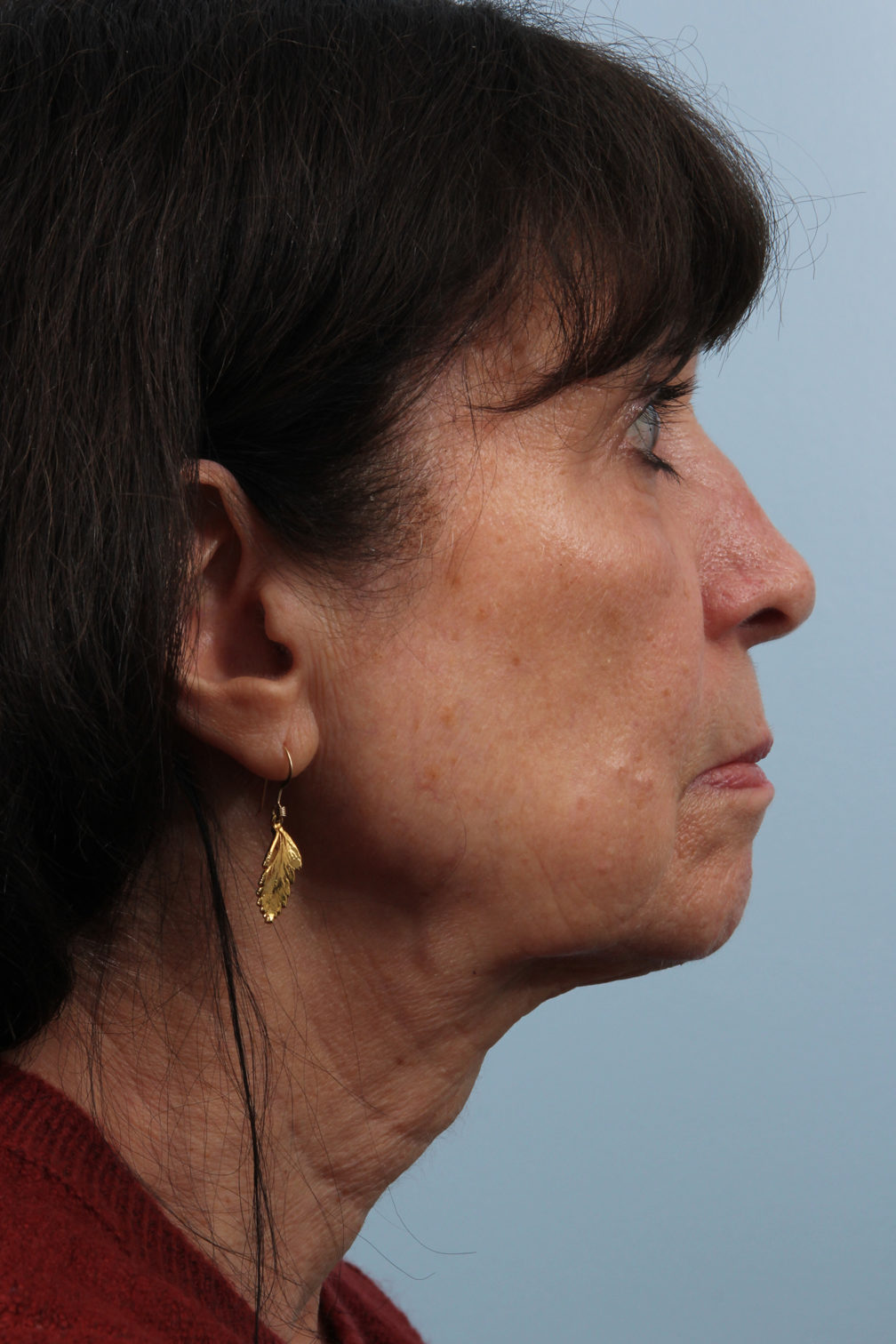 Weekend Facelift Pictures - Rhytidectomy | Williams Center Williams Center