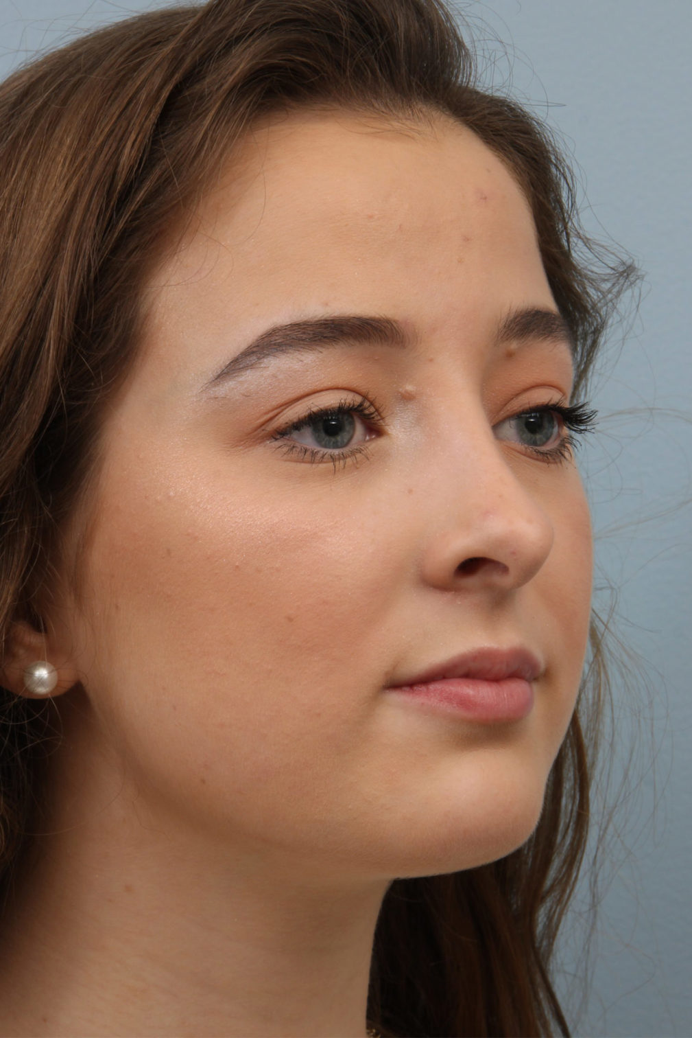 Rhinoplasty & Nasal Reconstruction Gallery | The Williams Center ...