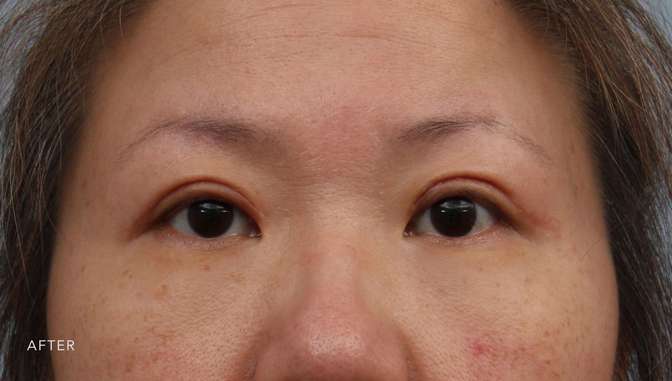 Blepharoplasty Pictures - Eyelid Surgery | Williams Center Williams Center