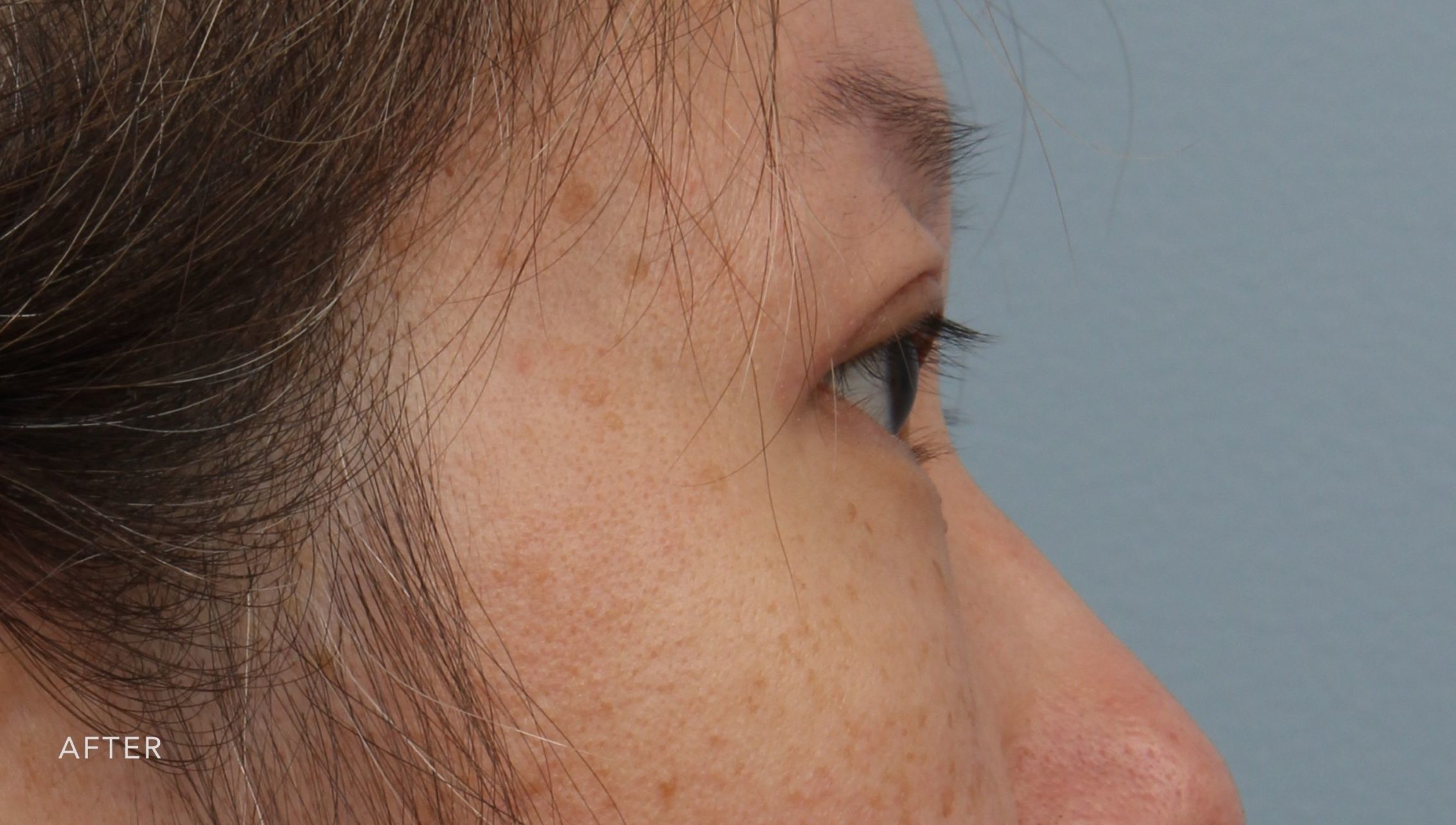 Blepharoplasty Pictures - Eyelid Surgery | Williams Center Williams Center