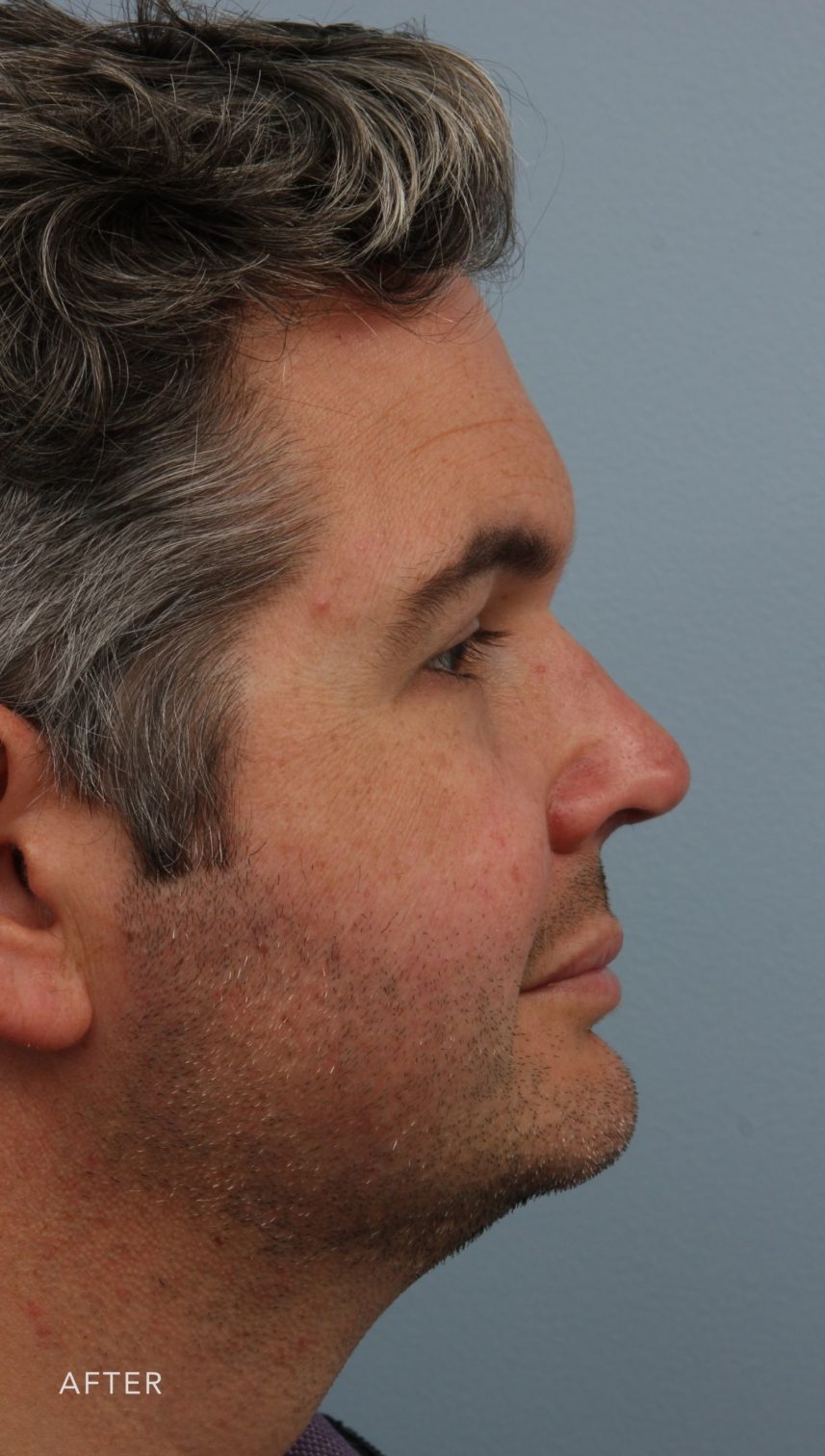 Rhinoplasty & Nasal Reconstruction Pictures | Williams Center Williams ...