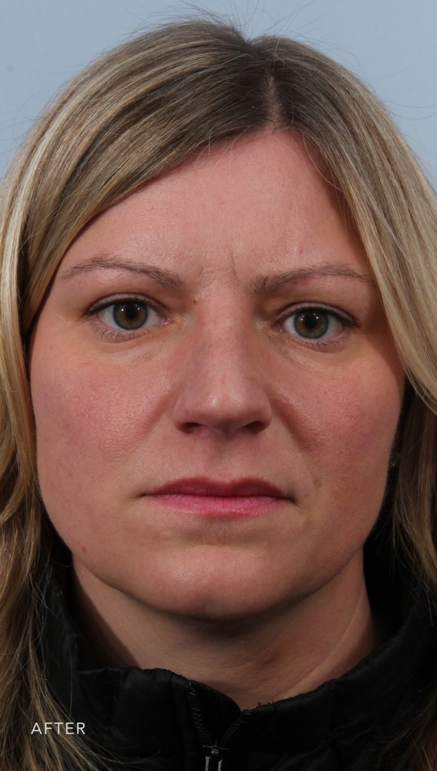 Rhinoplasty & Nasal Reconstruction Gallery | The Williams Center ...