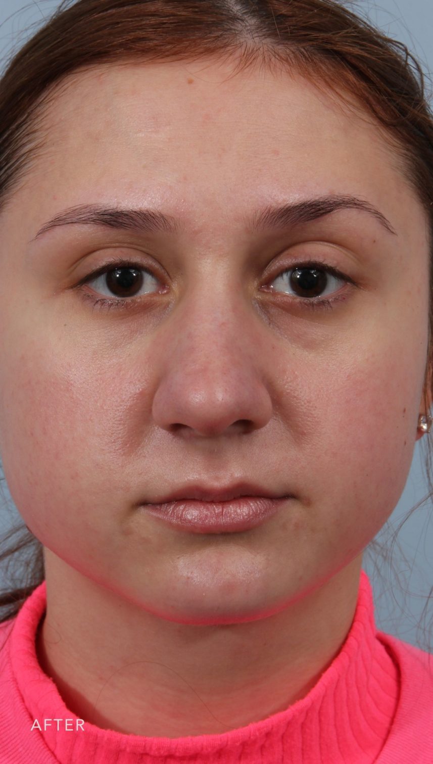 Rhinoplasty & Nasal Reconstruction Pictures | Williams Center Williams ...