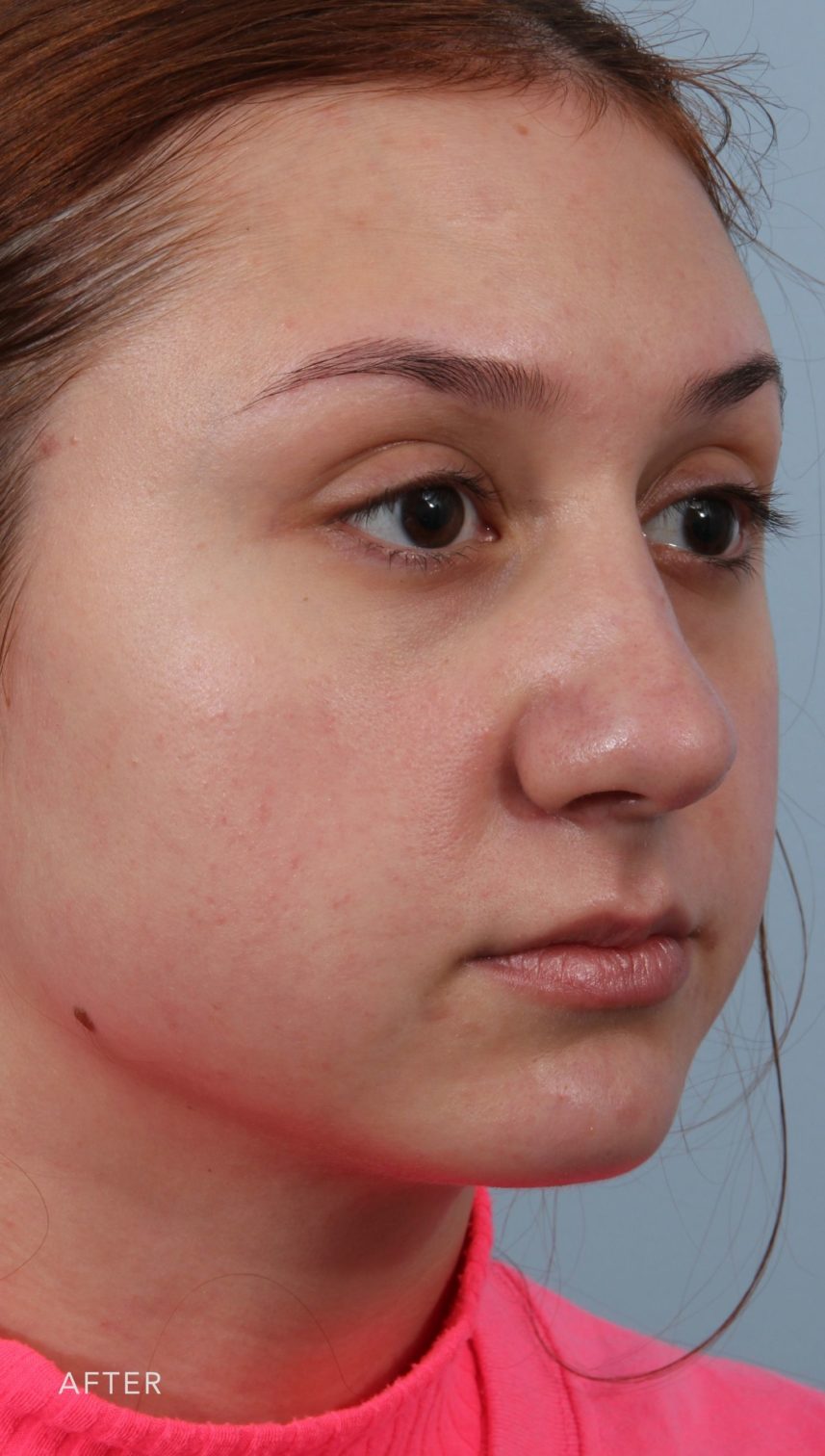 Rhinoplasty & Nasal Reconstruction Pictures | Williams Center Williams ...