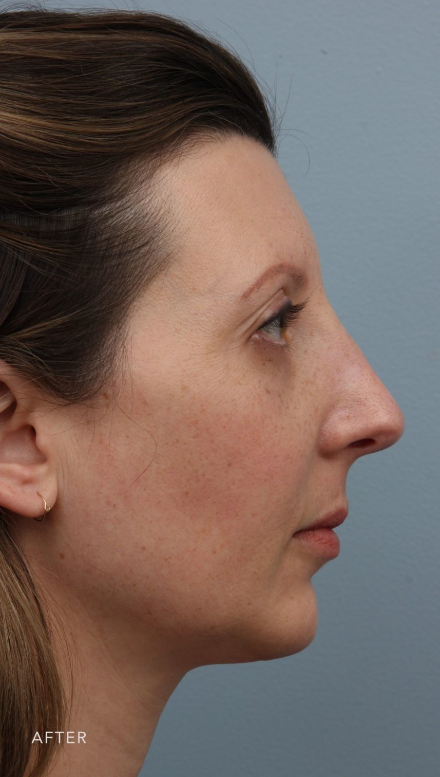 Rhinoplasty & Nasal Reconstruction Pictures | Williams Center Williams ...