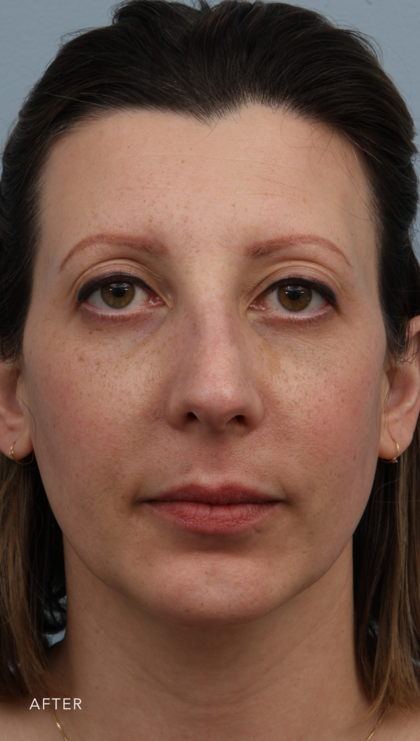 Rhinoplasty & Nasal Reconstruction Pictures | Williams Center Williams ...